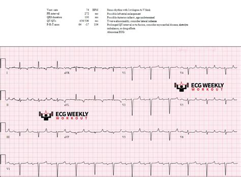 Differential Diagnoses Poor R Wave Progression Prolonged Qt Intervals