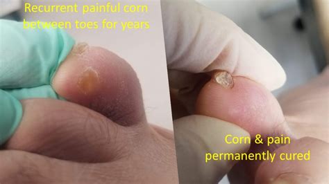 What Is The Meaning Of Corn Cure At Mary Lockridge Blog