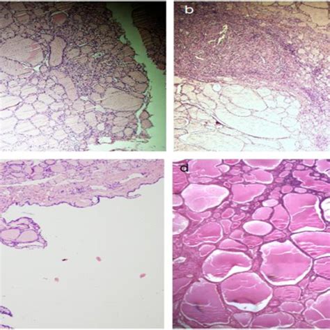 The Different Histological Types Of The Ectopic Thyroid And Normal