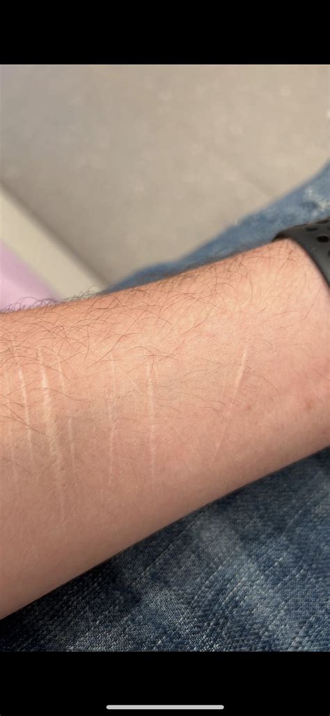 5 Month Old Neck Dissection Scar From Lymph Node Removal R Scars