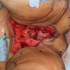 Figure B Intraoperative View Of Case Number A Defect Measuring Download Scientific