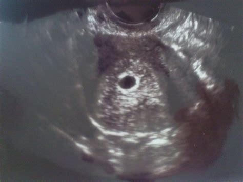How Does A Miscarriage Look Like At 4 Weeks