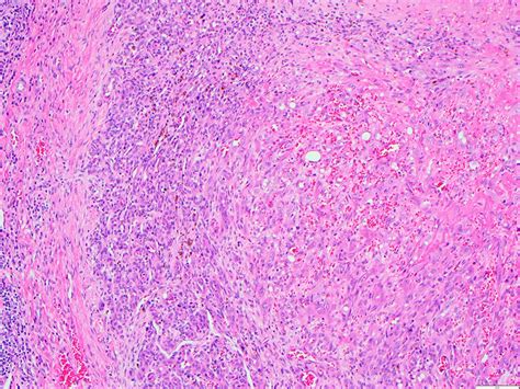 Epithelioid Angiosarcoma