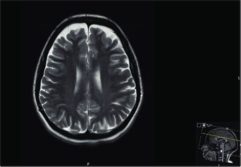 Mri T2 Weighted Axial Section Non Specific White Matter Lesion In Left Download Scientific