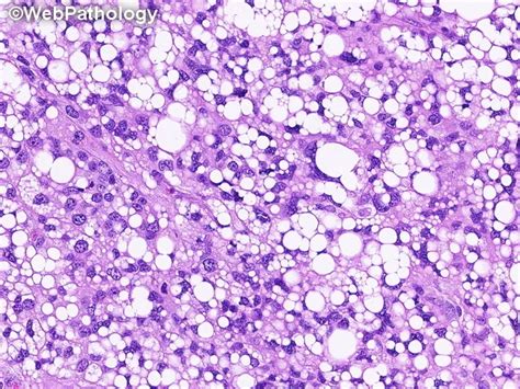 Liposarcoma Lipoblasts