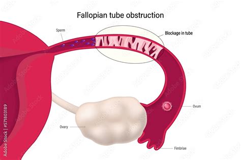 Fallopian Tube Obstruction Block Fallopian Tube Uterus And Uterine