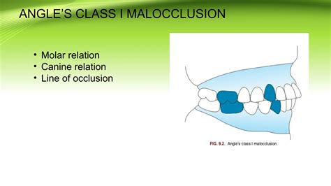 Angles Classification Of Malocclusion 2pptx