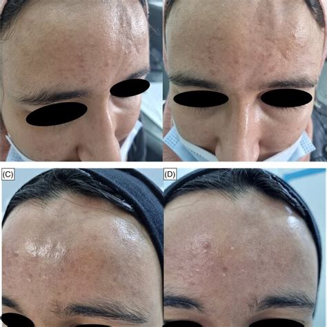A B A Median Atrophy Of The Forehead C D A Satisfying Result And