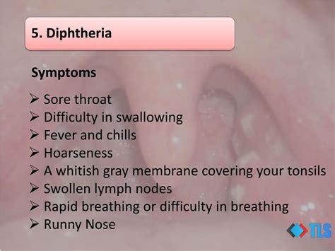 Ppt 8 Causes Of White Spots On Tonsils You May Not Know Powerpoint Presentation Id7321615