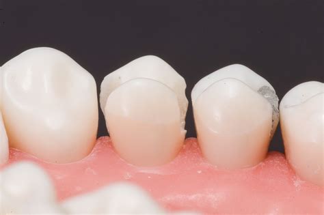 Operative Practical 12 Mod Prep And 13 Do Amalgam Fill
