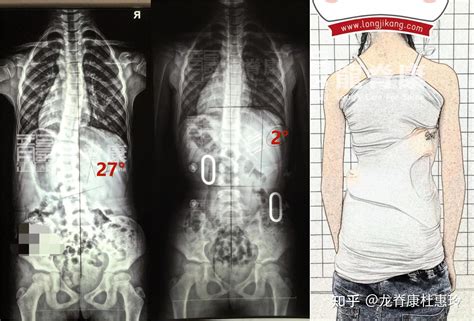 8岁侧弯女孩，治疗3个月后体态基本回直！ 知乎