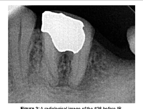 Figure 2 From Intentional Replantation A Viable Treatment Option For Bifurcation Perforation