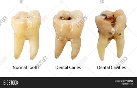 Normal Tooth Dental Image And Photo Free Trial Bigstock