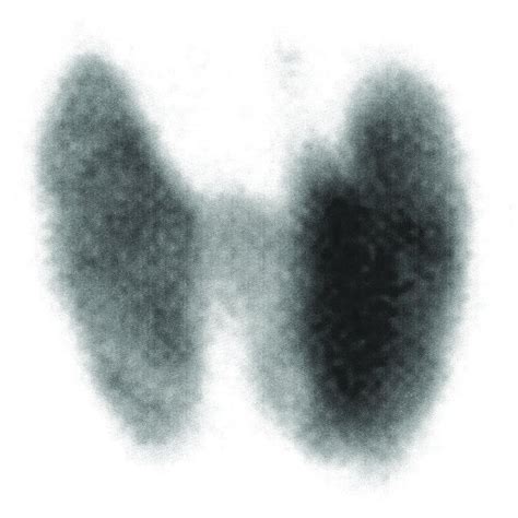 Thyroid Scan Shows An Increased Uptake Of Tracer And Diffuse Download Scientific Diagram