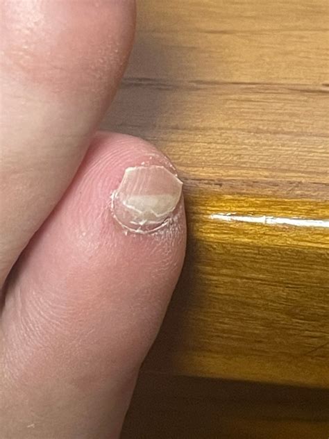 안녕하세요 혹시 무좀인가 해서 올려봅니다 지식in