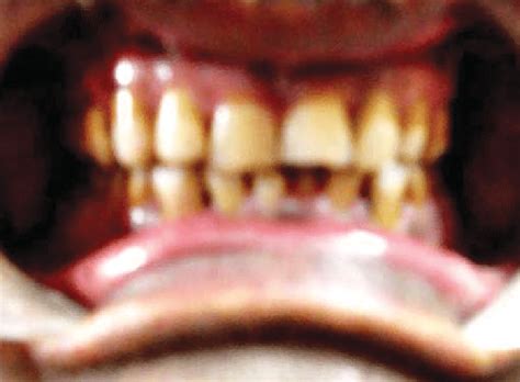 Postoperative Occlusion Download Scientific Diagram
