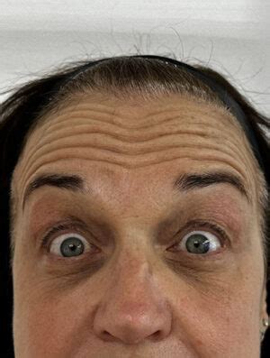 Daxxify Pure By Alpha Derm