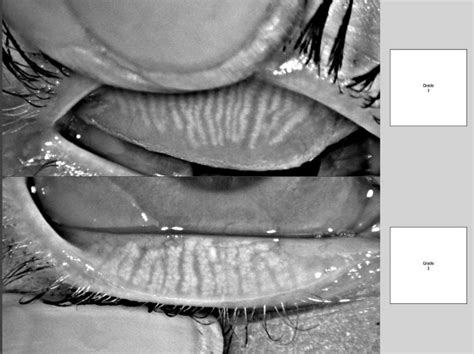 Meibomian Gland Imaging And Expression Dry Eye Equation