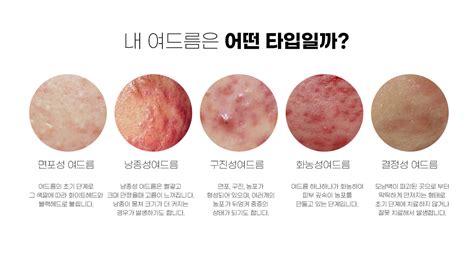 여드름 치료는 여드름의 가장 큰 문제인 염증을 대전세종시 피부과 진료과목연세에스의원and레이저클리닉