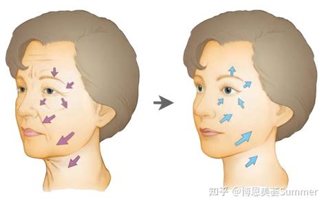 印第安纹在深圳哪里可以解决印第安纹怎么去除效果最好 知乎