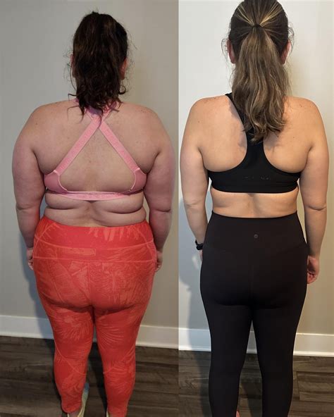 51 Glp 1 Photos Before And After Real Patient Results And