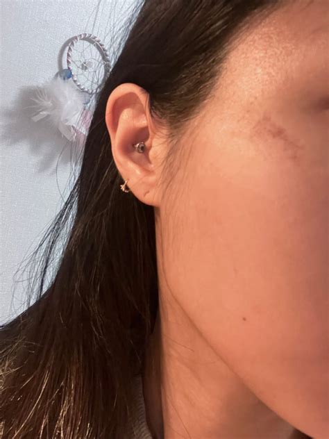 얼굴 긁힌 상처 어떤밴드 붙여야 하나요 지식in