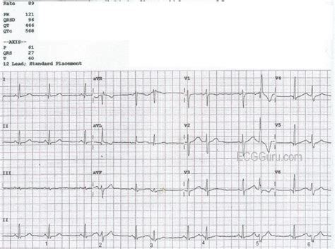 Aberrant Conduction Ecg Guru Instructor Resources