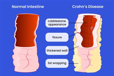 What To Know About Creeping Fat In Crohns Disease