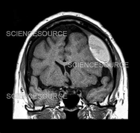 Photograph Mri Subdural Hematoma Science Source Images My Xxx Hot Girl