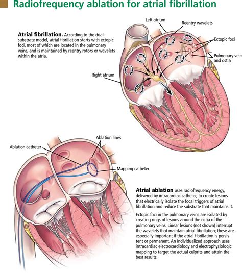 Figure 1 From Ablation Of Atrial Fibrillation What Can We Tell Our Patients Semantic Scholar