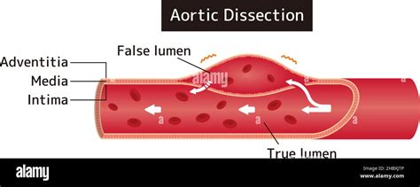 Vector Illustration Of Aortic Dissection Stock Vector Image And Art Alamy