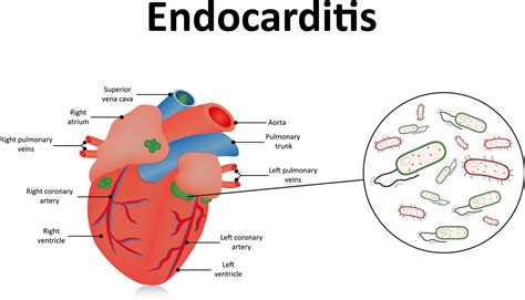 Streptococcus Mutans Scheda Batteriologica E Approfondimenti