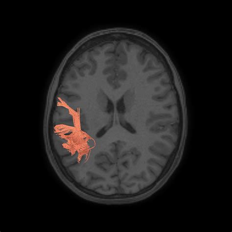 Dorsal Attention Network Connectome Guide