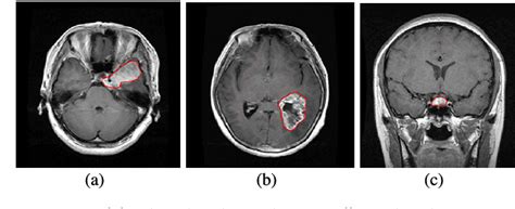 Figure 12 From Improved Brain Tumor Segmentation And Classification In Brain Mri With Fcm Svm A