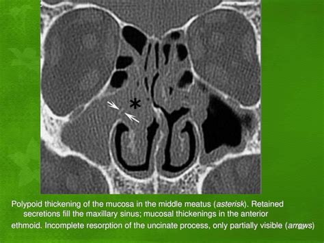 Cases Dr Harsha K J 3rd Yr Resident Dept Of Radiodiagnosis Ppt