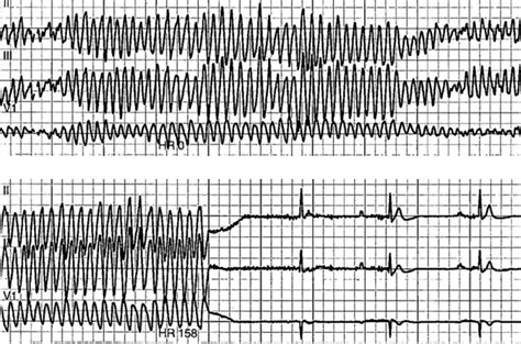 Polymorphic Ventricular Tachycardia Ventricular Tachycardia Treatment