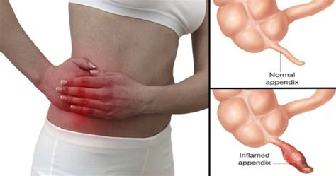 Warning Signs Your Appendix Is About To Burst Doctorbabu