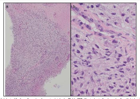 Figure 1 From A Case Of Primary Pulmonary Artery Intimal Sarcoma Semantic Scholar