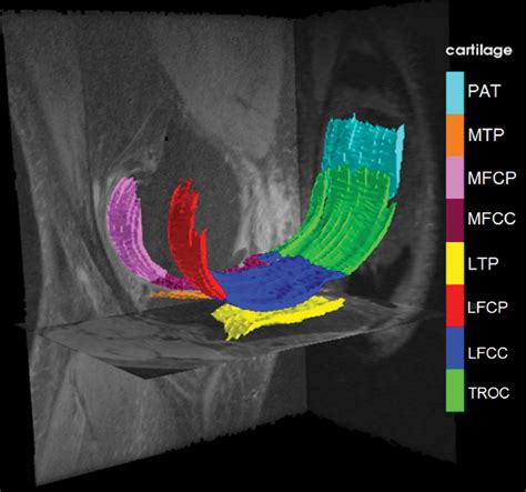 Articular Cartilage Of The Human Knee Joint In Vivo Multicomponent T2