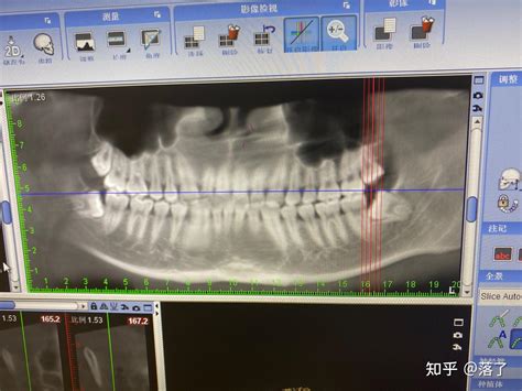 这样的智齿一定要拔吗 知乎