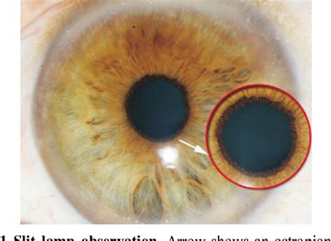 Angiography Reveals Early Hiding Iris Neovascularization After Ischemic