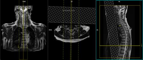 Mri Whole Spine Mri Whole Spine Protocol And Planning