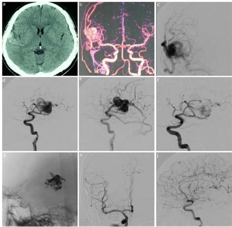 Embolizing Intracranial Arteriovenous Malformations With Onyx Experience At A Single Center