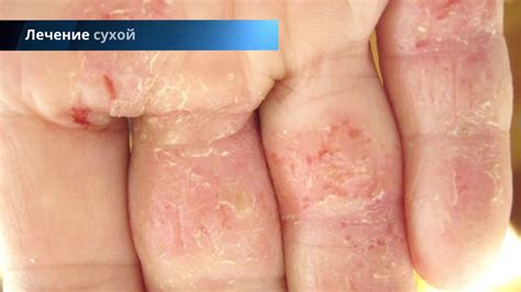 Тилотическая экзема причины симптомы и лечение