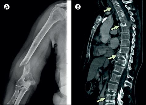Pathologic Fracture X Ray