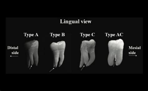 Radix Entomolaris And Paramolaris Style Italiano Endodontics