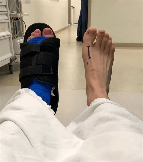 Whats A Cheilectomy Rfeetfirstclinic