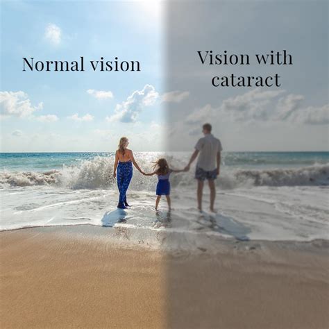 Cataract Vision Simulation