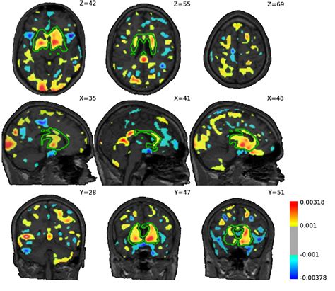 Figure 2 From Classification Of Schizophrenia Patients And Healthy Controls From Structural Mri