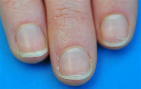 Nail Problems Nhs